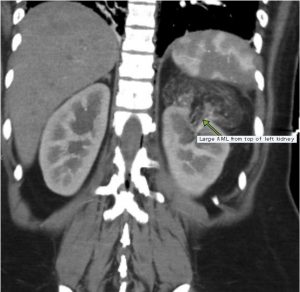 RENAL ANGIOMYOLIPOMA EMBOLIZATION | Consulting Radiologists