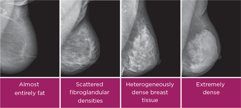 Breast Density: Understanding its Significance and Impact on Breast Health | Consulting Radiologists