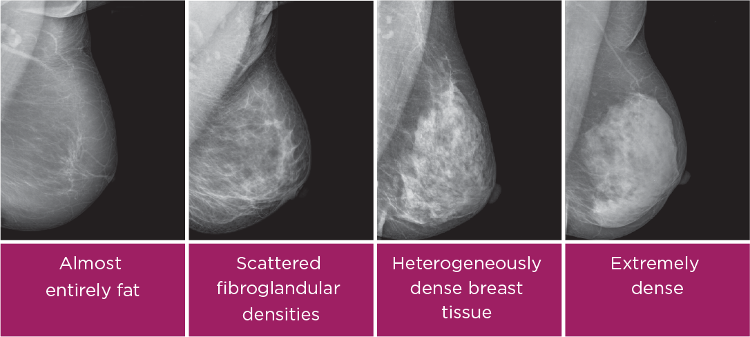 Breast Density Understanding Its Significance And Impact On Breast
