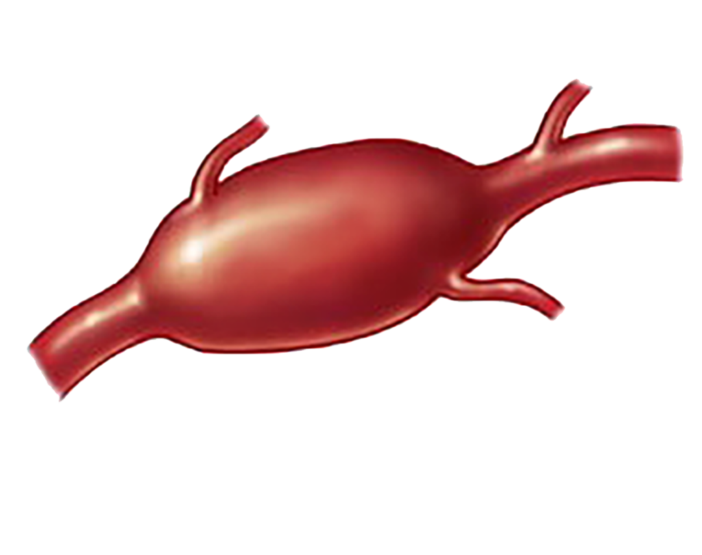 Brain Aneurysms: A Family Connection | Consulting Radiologists