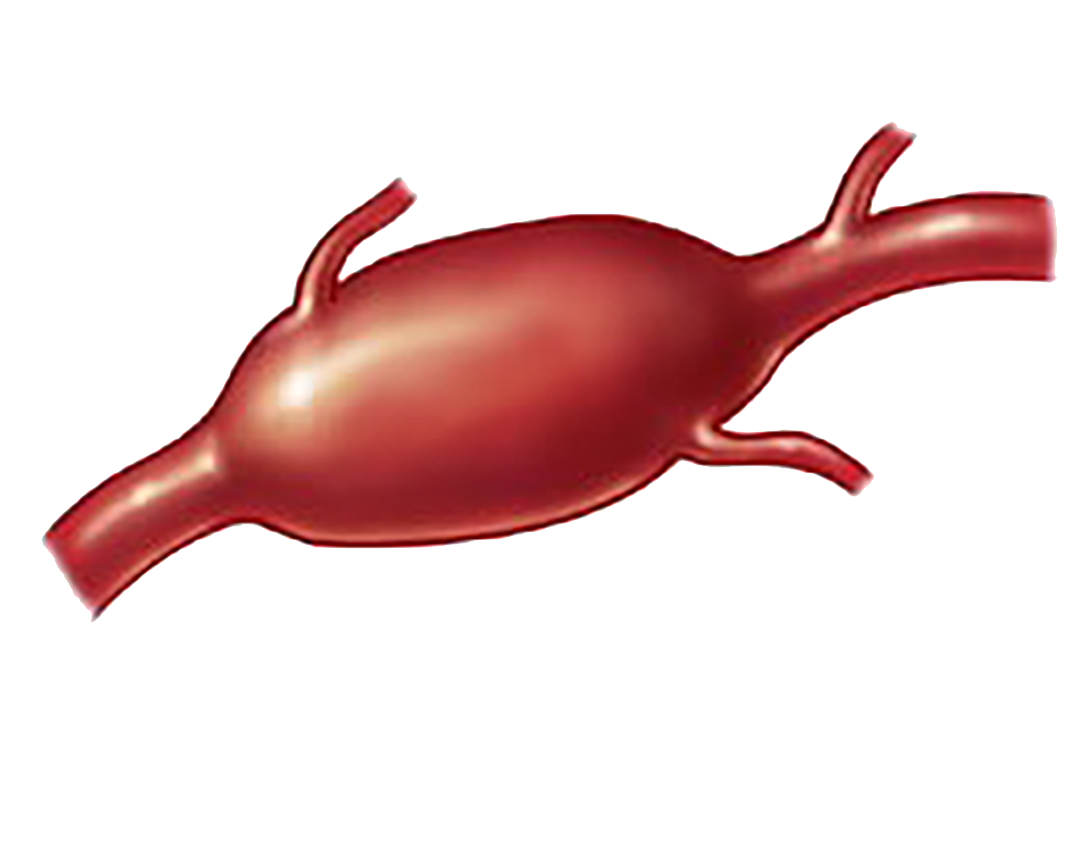 Brain Aneurysms: A Family Connection | Consulting Radiologists